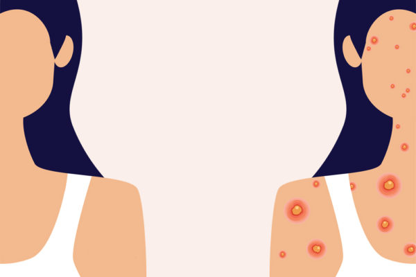 Monkeypox and Pregnancy: What You Need to Know - Pregnancy & Newborn ...